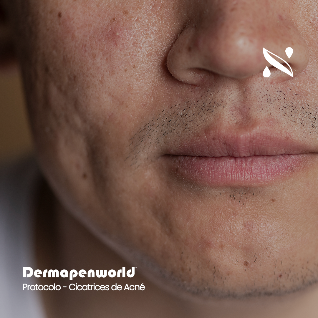 Dermapen 4 Cicatrices de Acné – Remodelación Dérmica Profunda ...